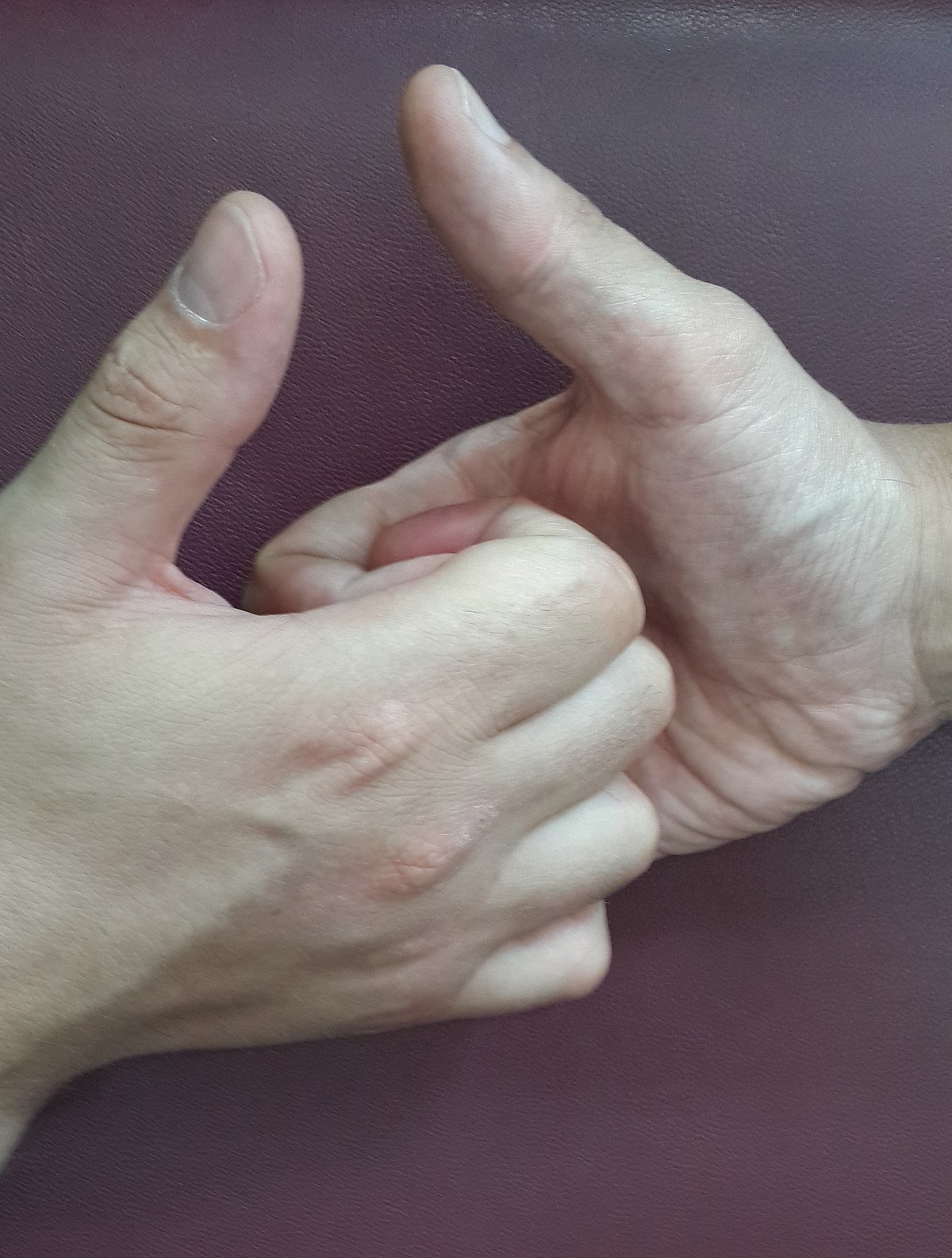 Simple Thumb Test Can Reveal if You're at Risk for Condition That Can ...